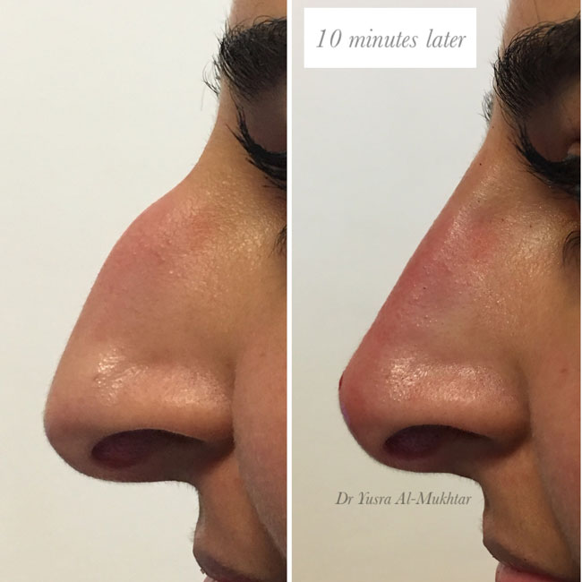 Nose Correction – Enliven Aesthetics